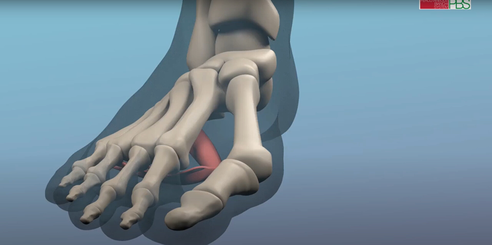 ArtStation - Medical Animation - PBS Technique to correct Hallux Valgus