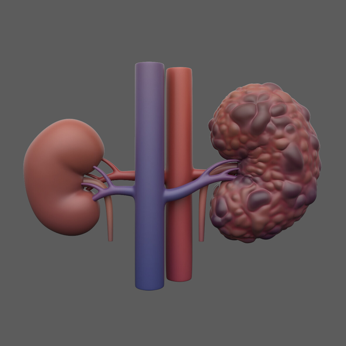 ArtStation - Polycystic Kidney Model & Animation