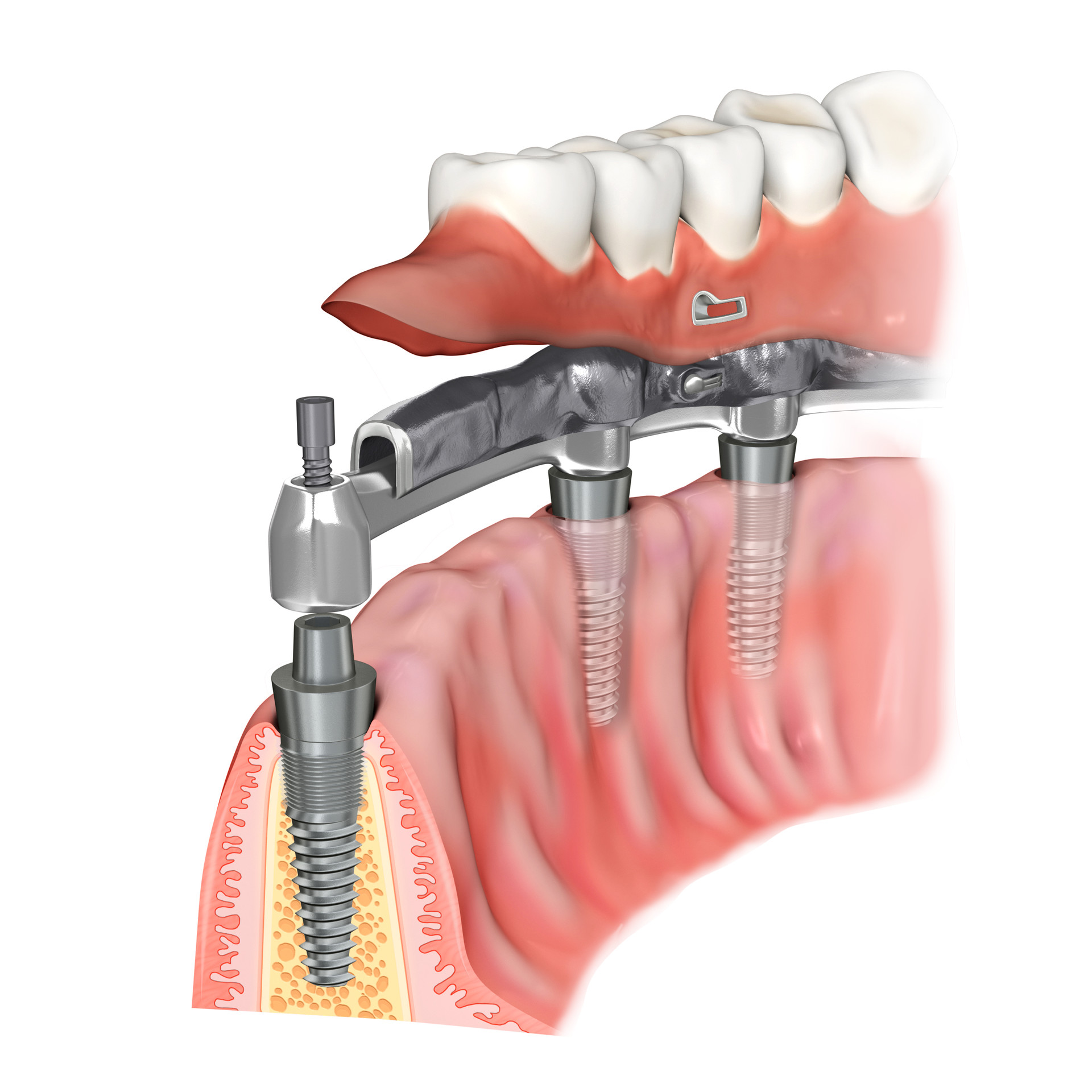 ArtStation - Illustrations for dental implant clinic