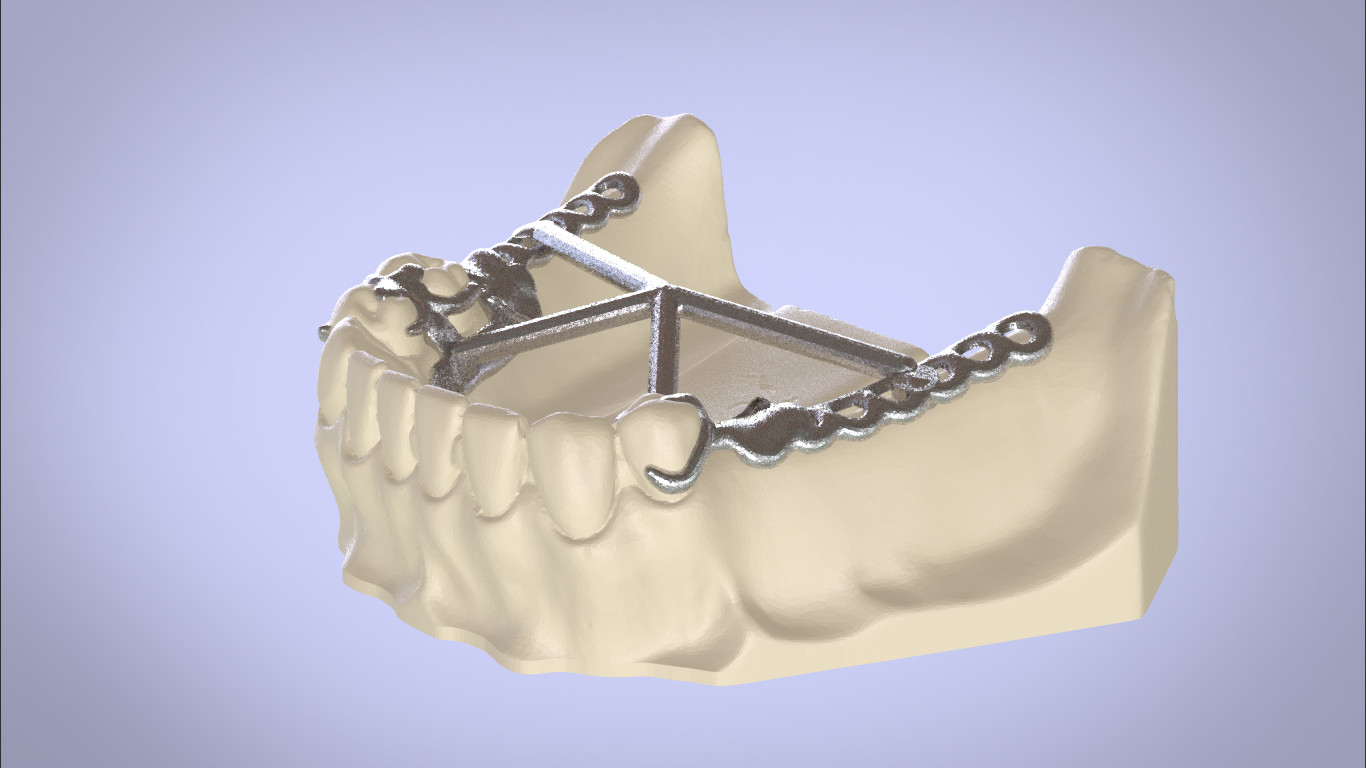 LabMagic 3D DentCAD - Digital 3D Removable Partial Denture