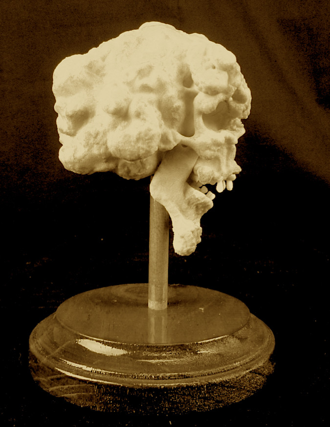 Joseph Merrick Skeleton