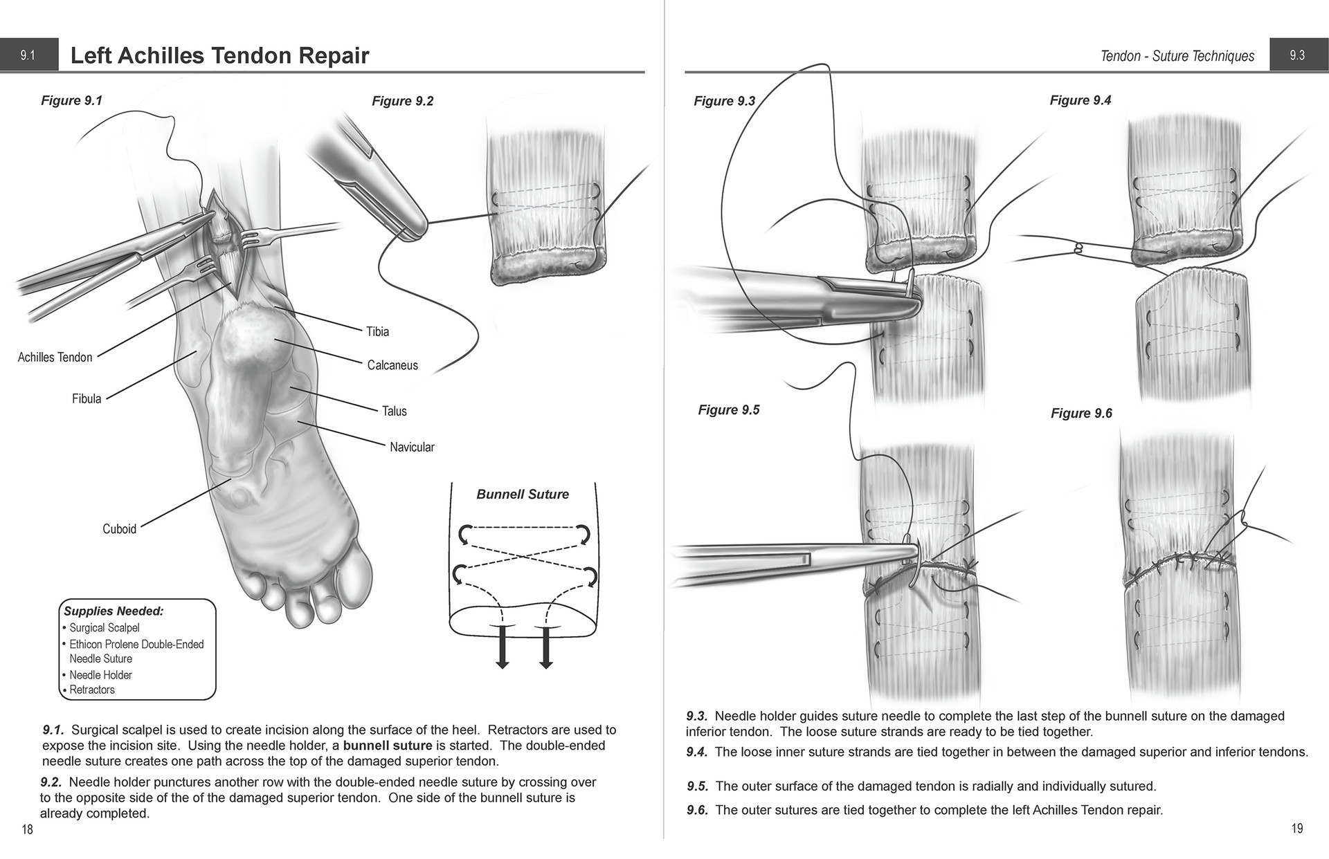 ArtStation - Left Achilles Tendon Repair, Lauren Kubacki