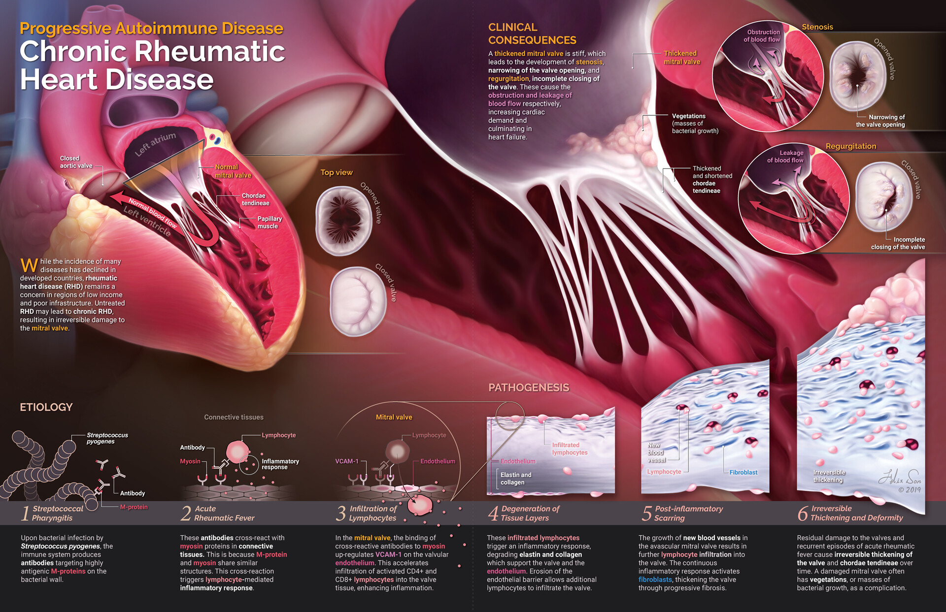 rheumatic fever pathogenesis