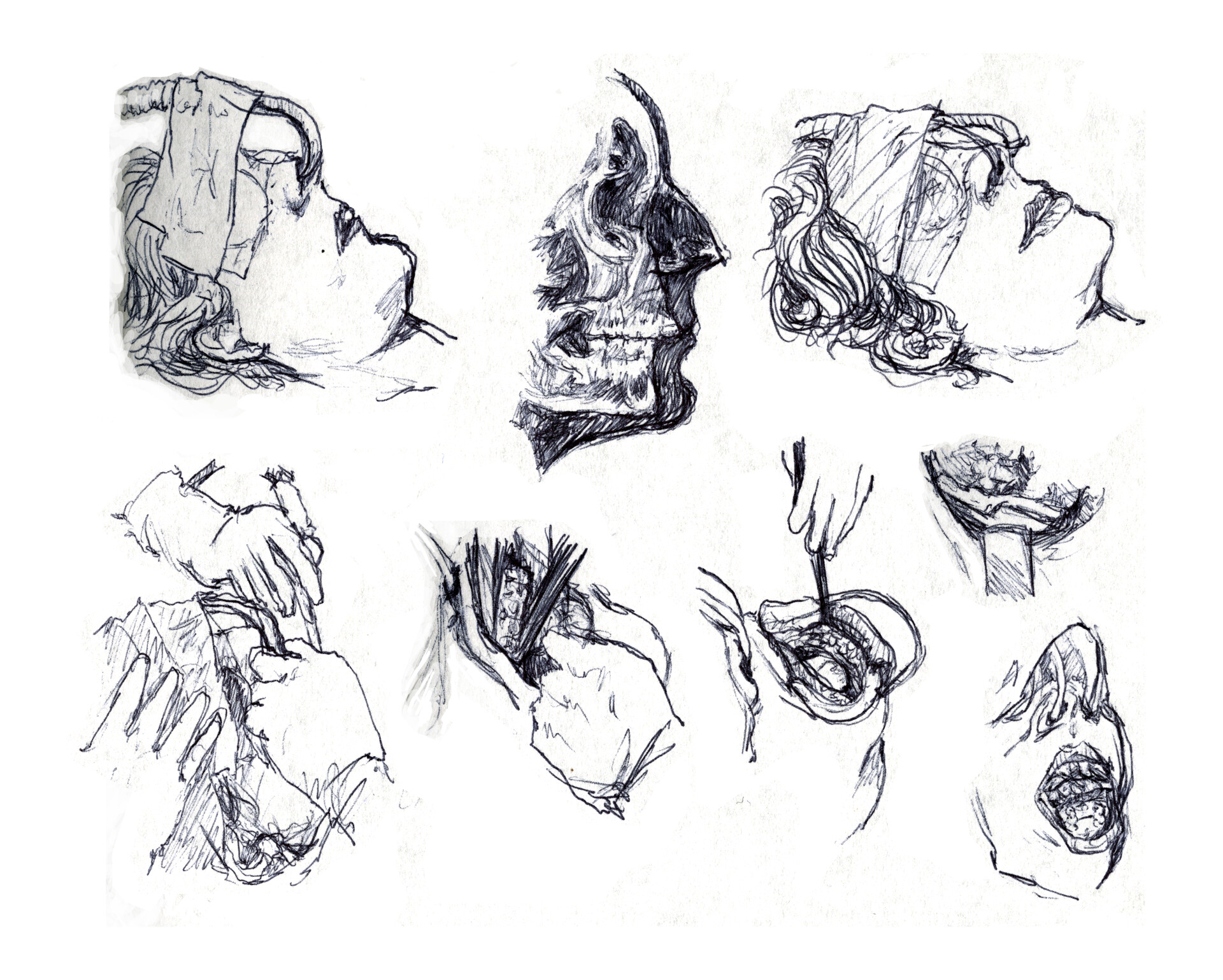 ArtStation - BSSO & Genioplasty