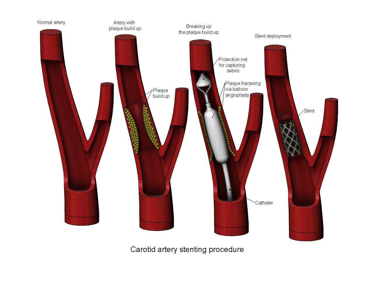 ArtStation - 3d printable Carotid artery stenting procedure diorama model