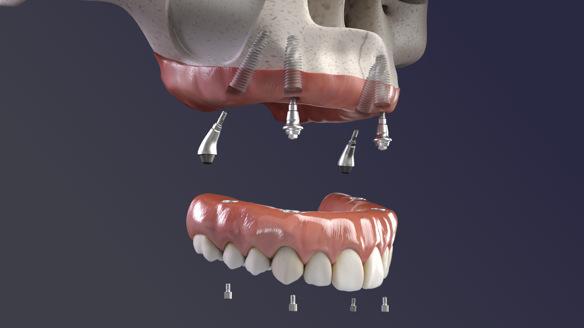 ArtStation - Dental Fixed Full-Arch Solution
