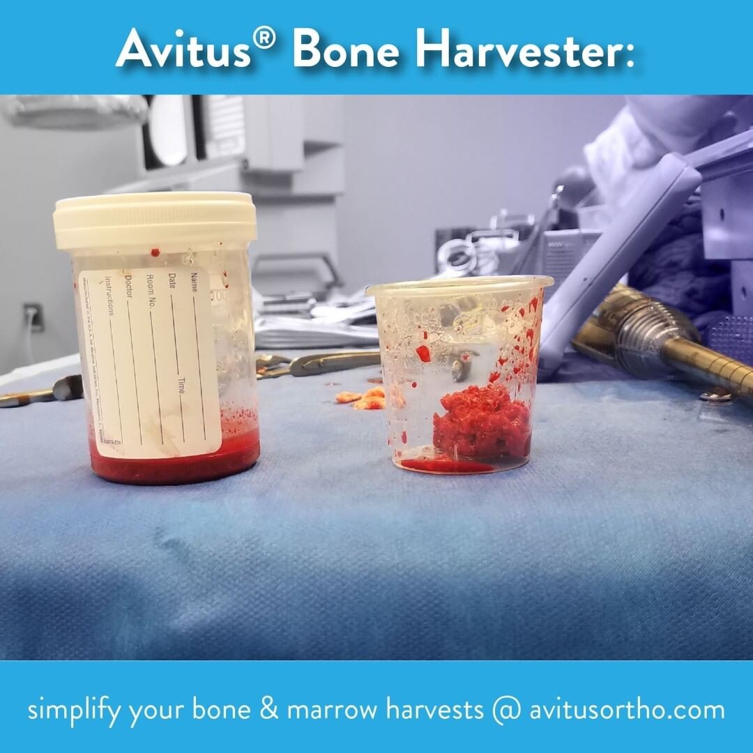 ArtStation - What Is Bone Graft Harvesting?