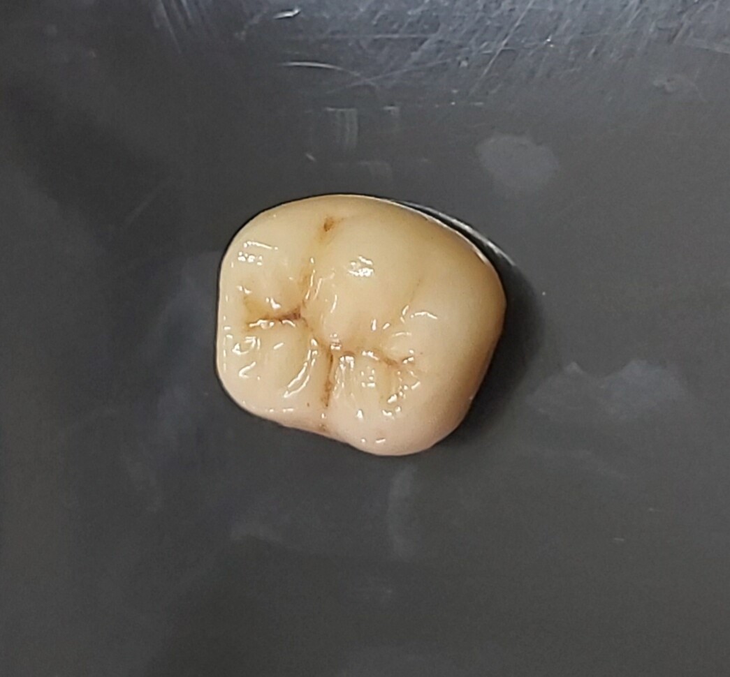 ArtStation - molar crown