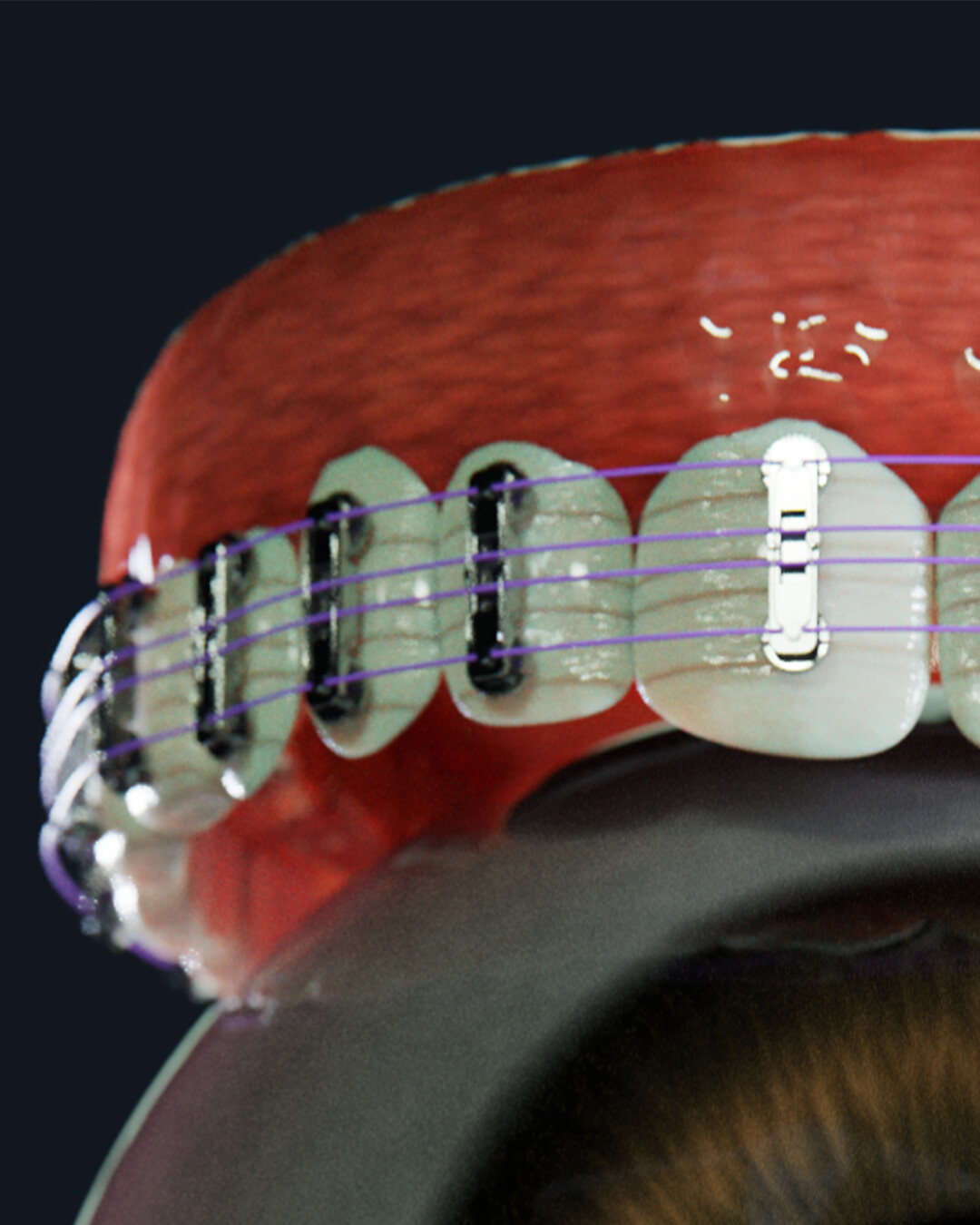 Randy Bruner - Braces