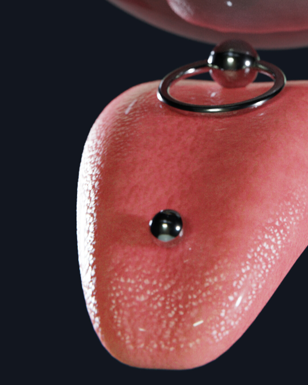 Randy Bruner - Braces