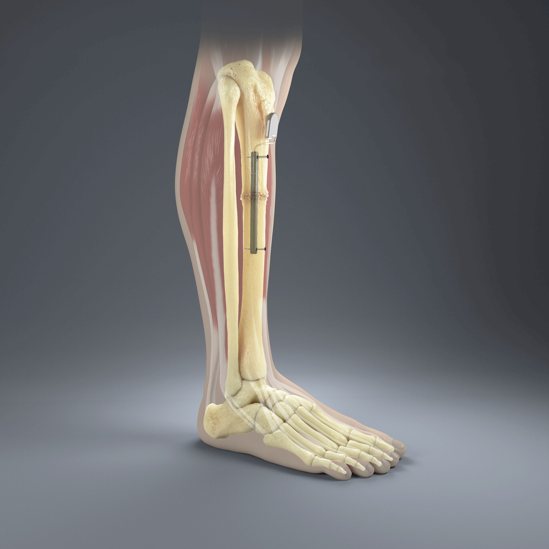 Leg Bone Extension Surgery at Donte Galiano blog