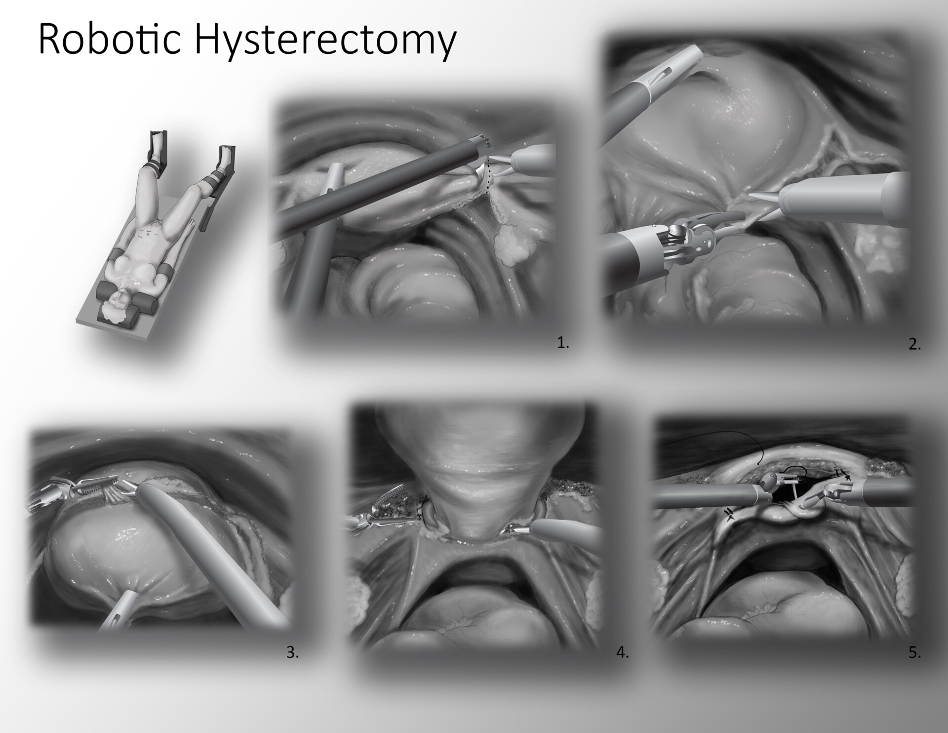 ArtStation - Robotic Hysterectomy