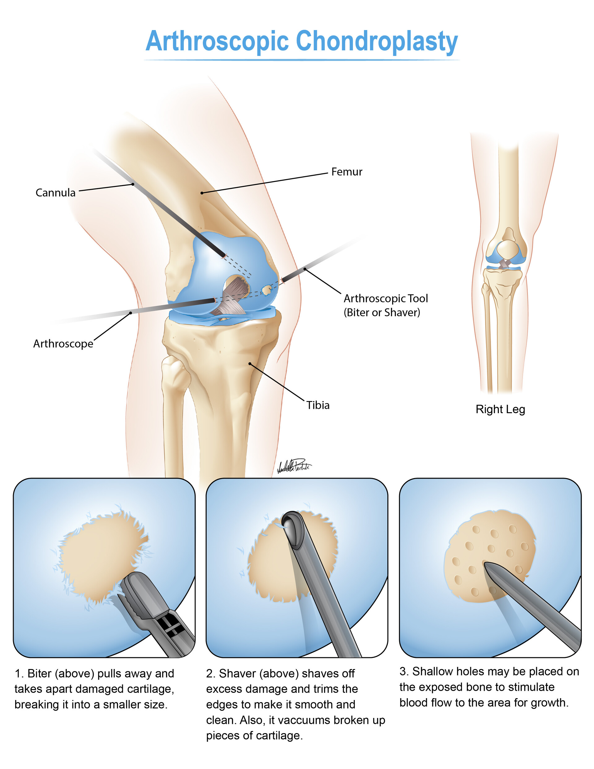 ArtStation - Arthroscopic Chondroplasty