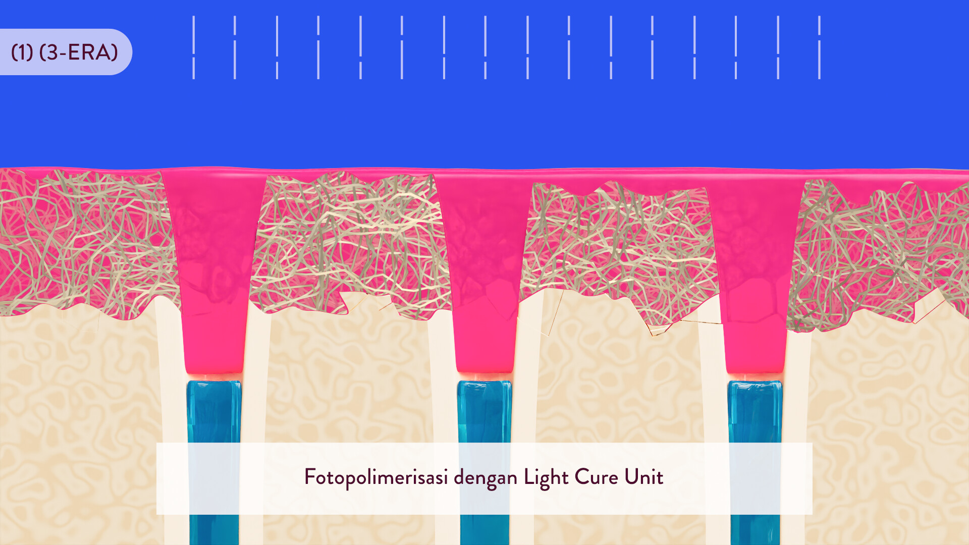 Bambang Suhendra - BONDING MECHANISM OF ADHESIVE SYSTEMS - MEDICAL ...