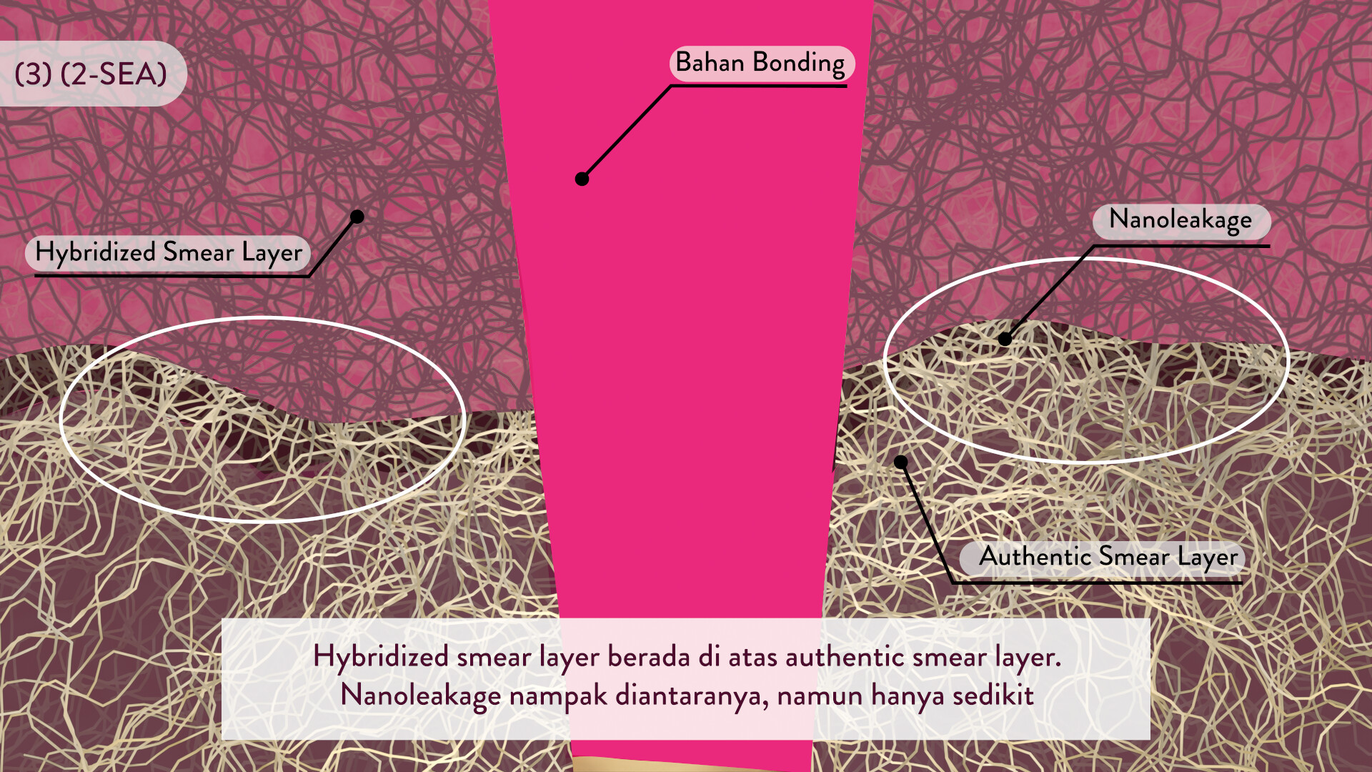 Bambang Suhendra - BONDING MECHANISM OF ADHESIVE SYSTEMS - MEDICAL ...