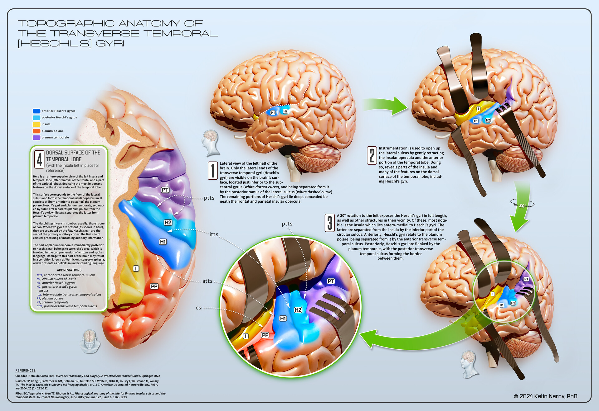 ArtStation - Anatomy Of The Human Brain: The Heschl's Gyri