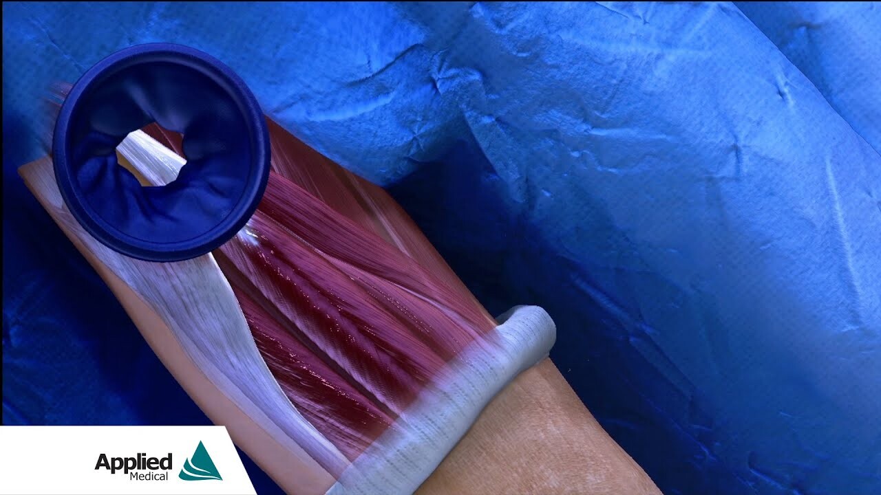 ArtStation - Placement of Alexis® Orthopaedic Protector for Total Hip ...