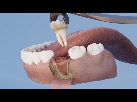 ArtStation - Molar tooth extraction 3D animation