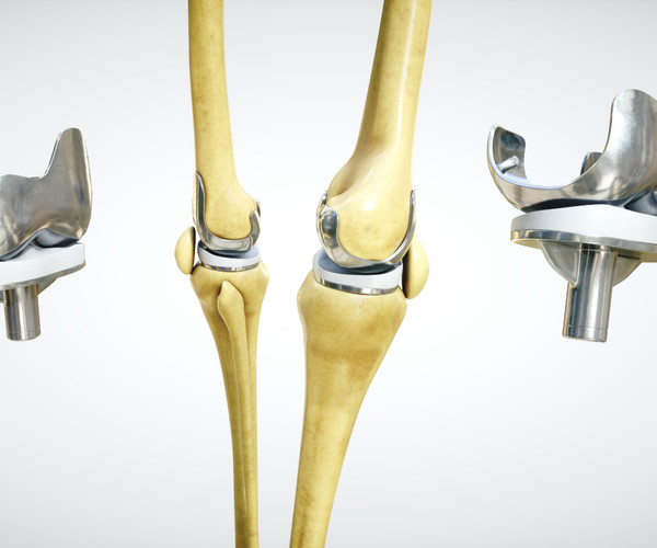 ArtStation - Knee endoprosthesis | Resources