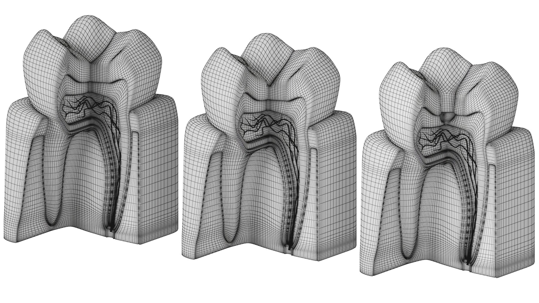 ArtStation - Tooth decay stages cavity caries | Resources