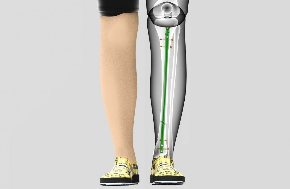 ArtStation - Tibial Intramedullary Nail | Resources