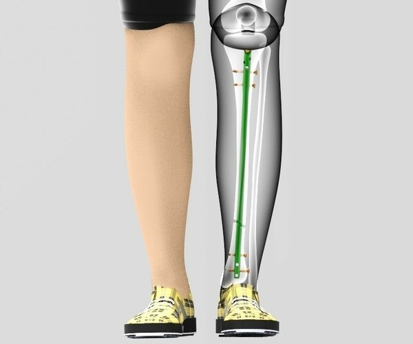 ArtStation - Tibial Intramedullary Nail | Resources