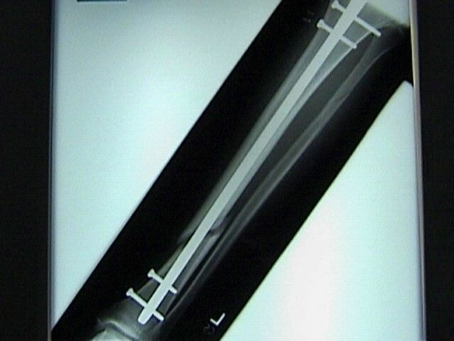 ArtStation - Tibial Intramedullary Nail | Resources