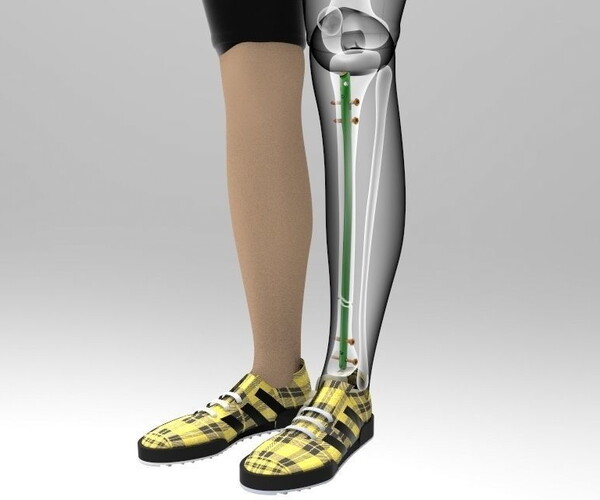 ArtStation - Tibial Intramedullary Nail | Resources